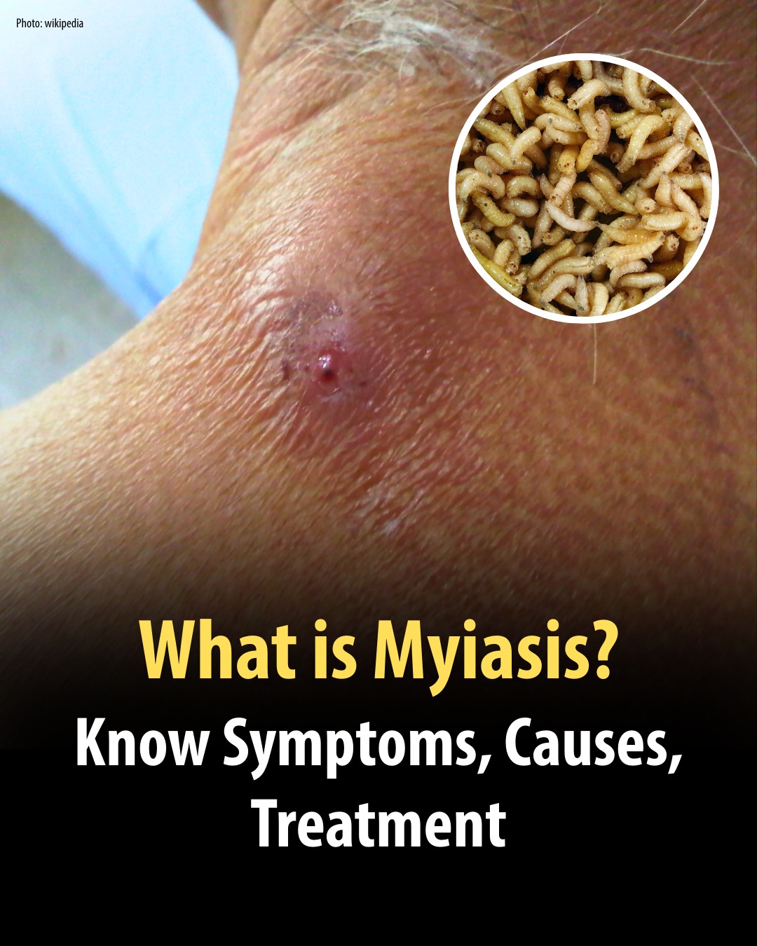 What Is Myiasis? Know Symptoms, Causes, Treatment – viralblog
